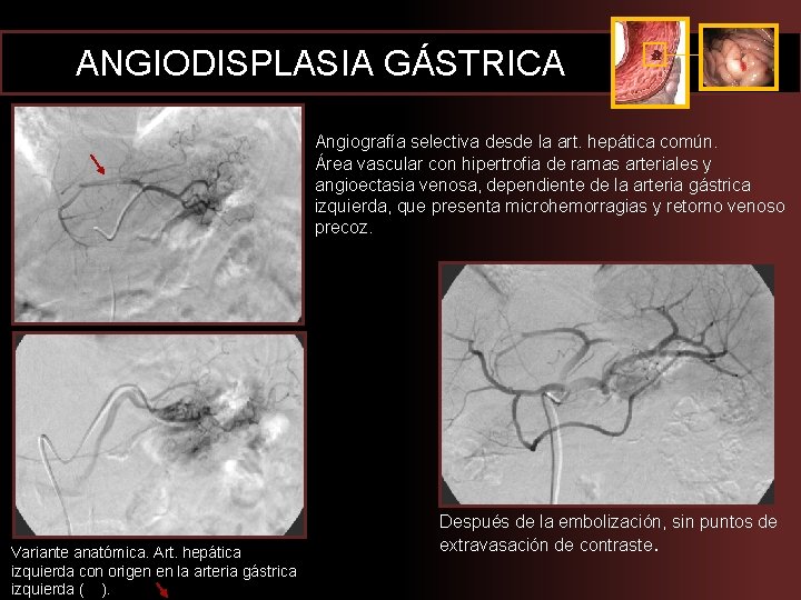 Embolizacin arterial en la HEMORRAGIA DIGESTIVA ALTA severa