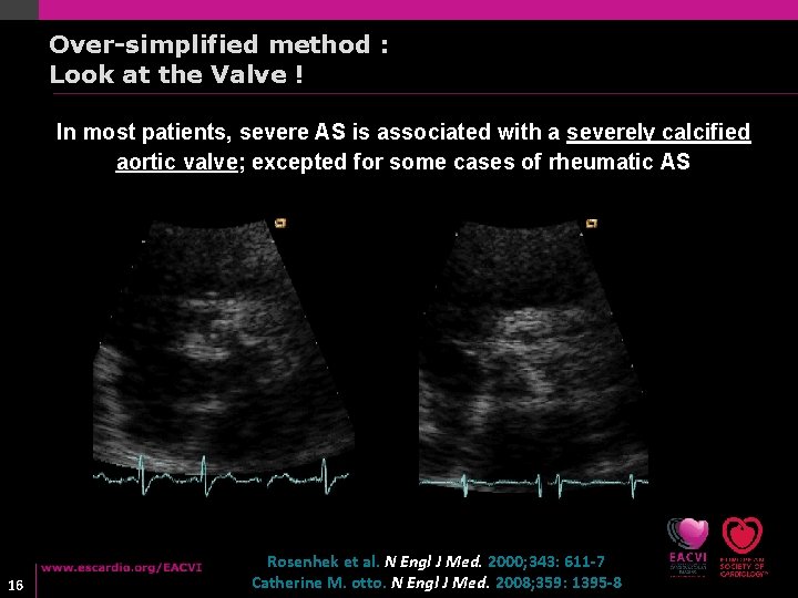 Lowgradient Lowflow aortic stenosis with low LV ejection