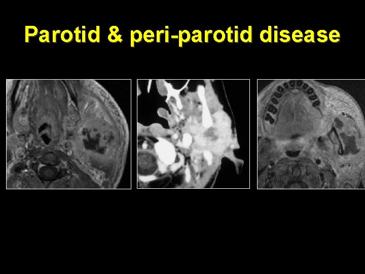 Imaging in Acute Facial Nerve Paralysis M Castillo
