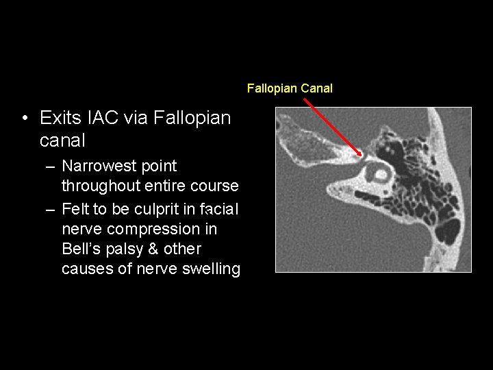 Imaging in Acute Facial Nerve Paralysis M Castillo