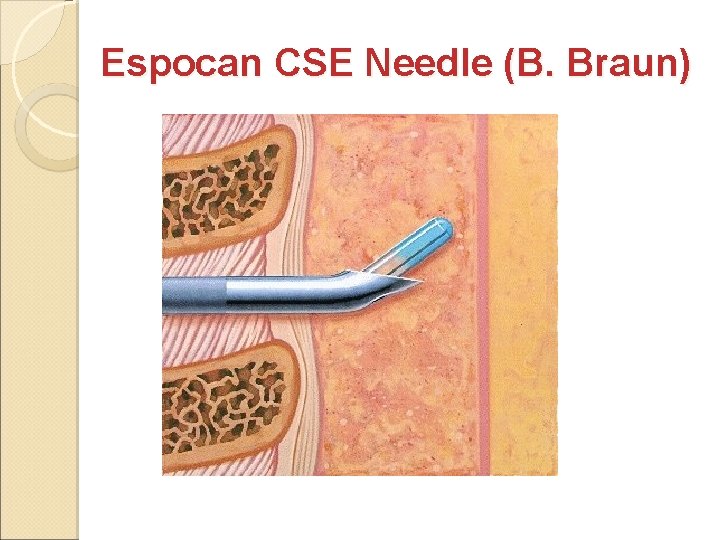 Regional Analgesia and Anesthesia for Labor and Delivery