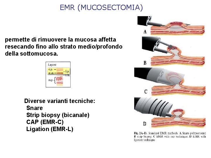 Endoscopic Mucosal Resection EMR AND Endoscopic Submucosal Dissection