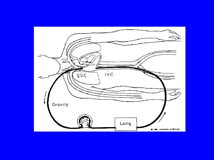 ECMO extracorporeal membrane oxygenation extracorporal life support 2010922