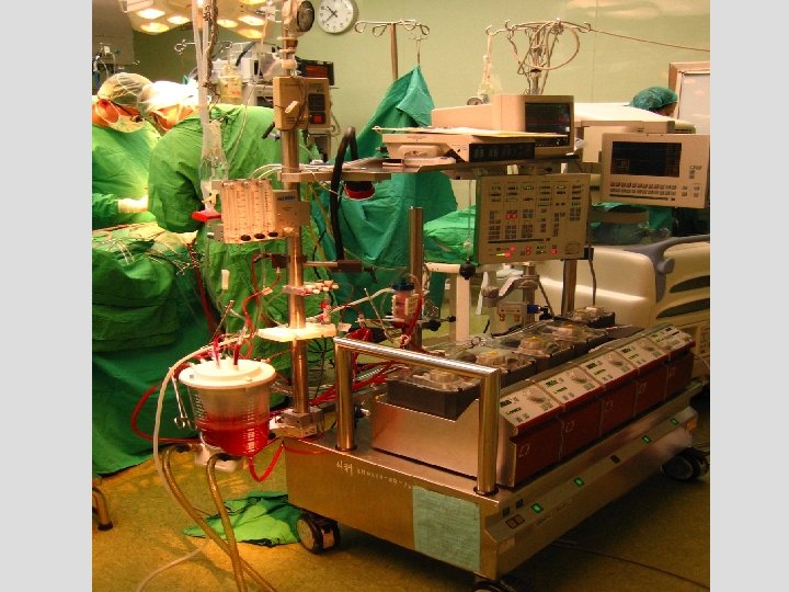 ECMO extracorporeal membrane oxygenation extracorporal life support 2010922