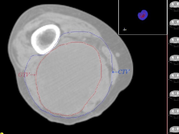 RTOG Extremity Soft Tissue Sarcoma Atlas RTOG Sarcoma