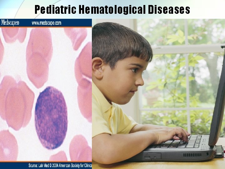 Pediatric Hematological Diseases Hemophilia Hemophilia Factor VIII ...
