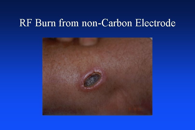 HOW I DO CMR SCANNING SAFELY Elisabeth Burman