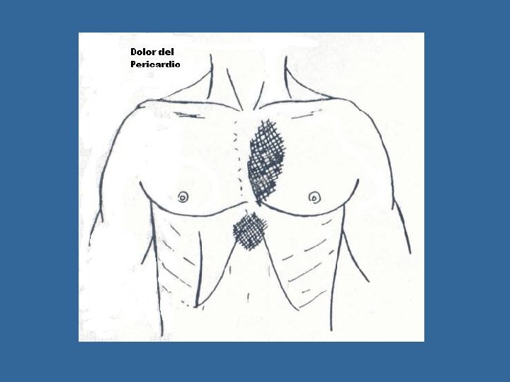 DOLOR TORCICO Dr David Prez Lora TIPOS DE