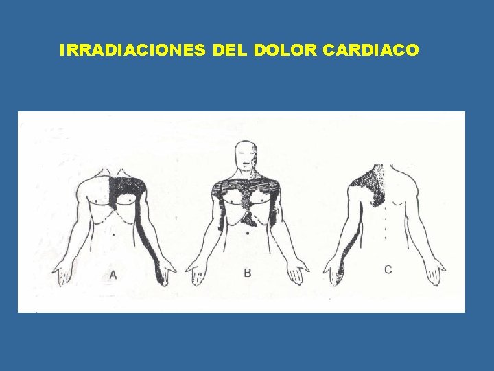 DOLOR TORCICO Dr David Prez Lora TIPOS DE