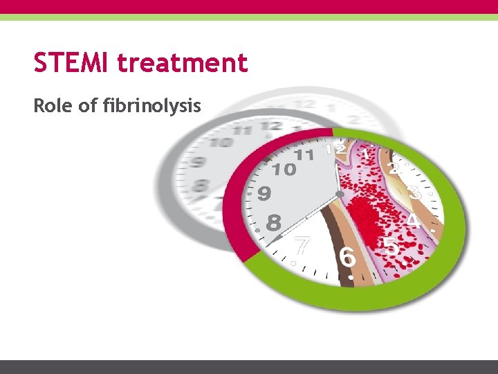 STEMI treatment Role of fibrinolysis Content Importance of