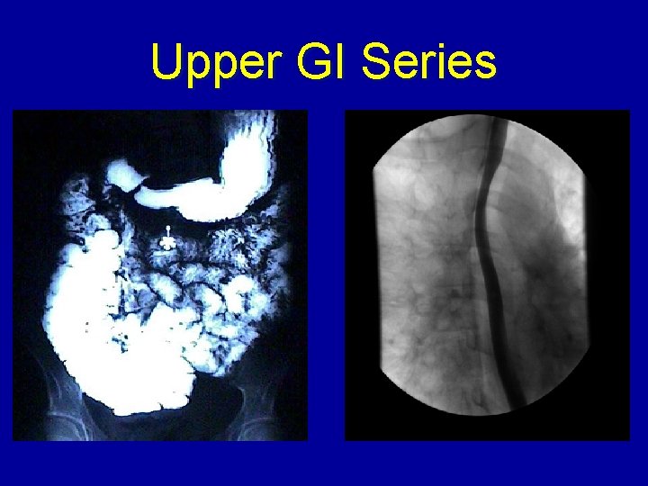 Gastroesophageal Reflux in Children By Karla Au Yeung