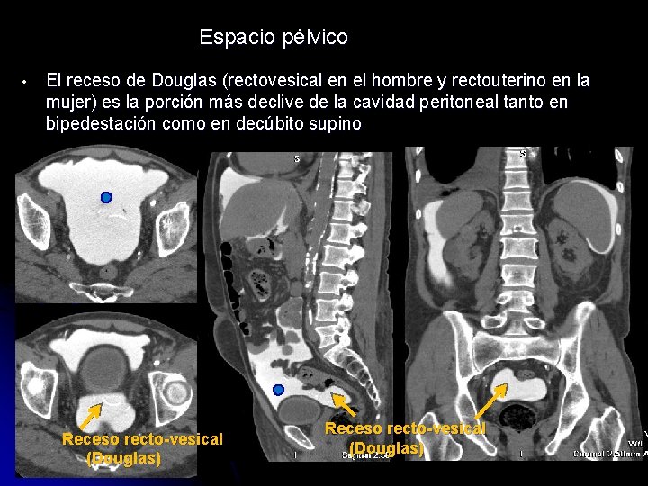 ANATOMA DEL PERITONEO Juan Calvo Blanco Rafael Menndez