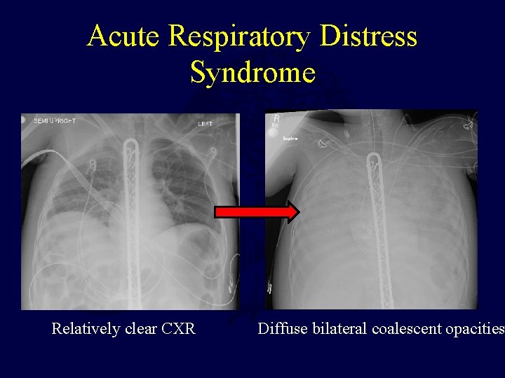 Acute Respiratory Distress Syndrome Fat Embolism Thromboembolic Disease