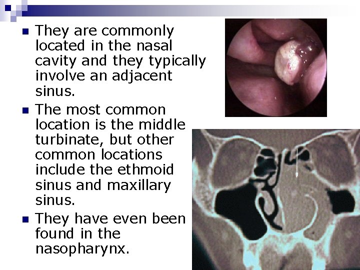 Sinonasal Tumours n Tumors of the nasal cavity