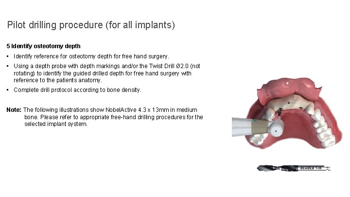 Pilot Drilling procedure for all implants including Nobel