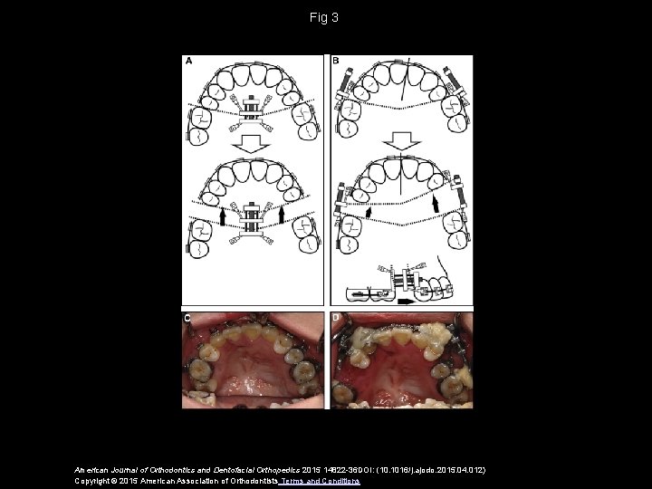 Evolution of Class III treatment in orthodontics Peter