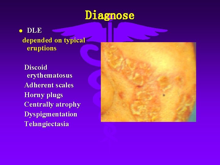 Lupus erythematosus Definition Lupus erythematosus LE is classified