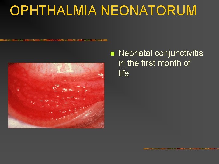 OPHTHALMIA NEONATORUM OPHTHALMIA NEONATORUM n Neonatal conjunctivitis in