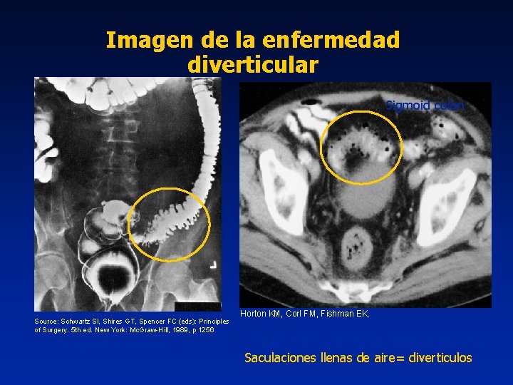 Enfermedad diverticular Divertculo Formacin sacular consistente en mucosa