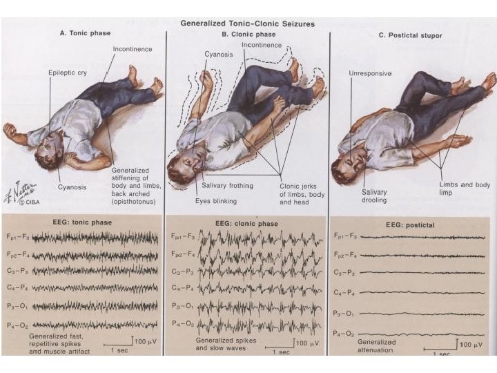 1 Electroencephalography Definition EEG is a surface recording