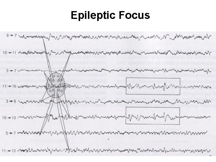 1 Electroencephalography Definition EEG is a surface recording