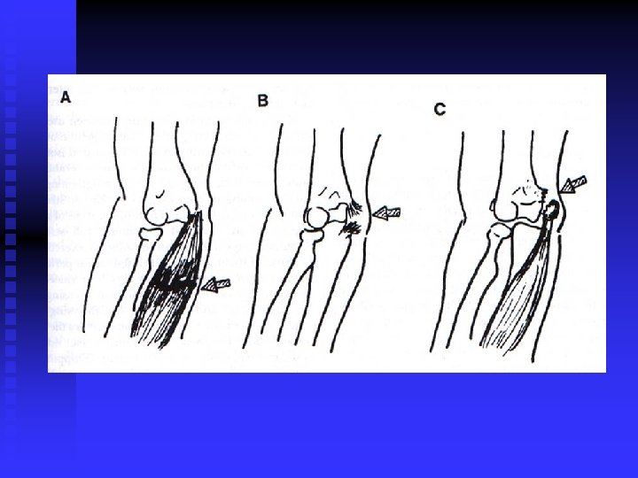 Elbow Lateral Epicondylitis tennis elbow n Pathology u