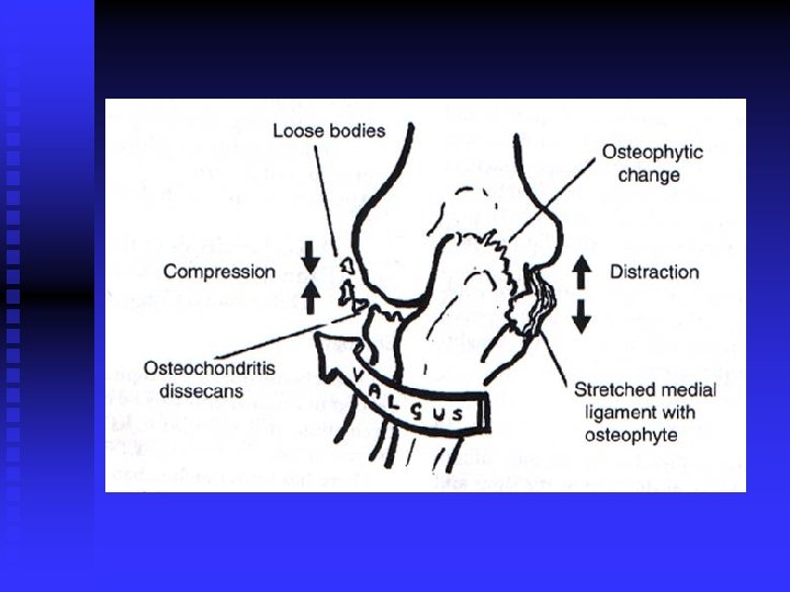 Elbow Lateral Epicondylitis tennis elbow n Pathology u