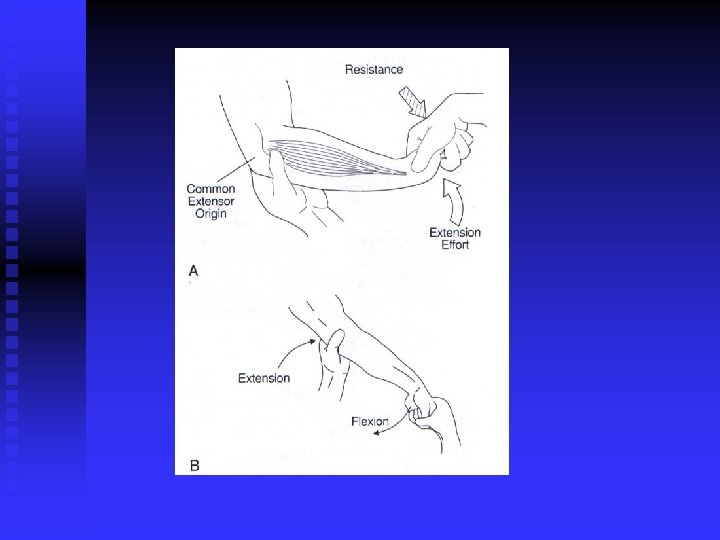 Elbow Lateral Epicondylitis tennis elbow n Pathology u