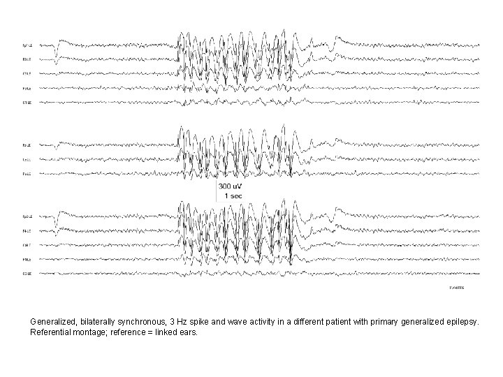 Introduction to EEG for nonepileptologists working in seizure