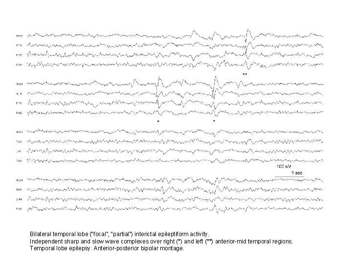 Introduction to EEG for nonepileptologists working in seizure