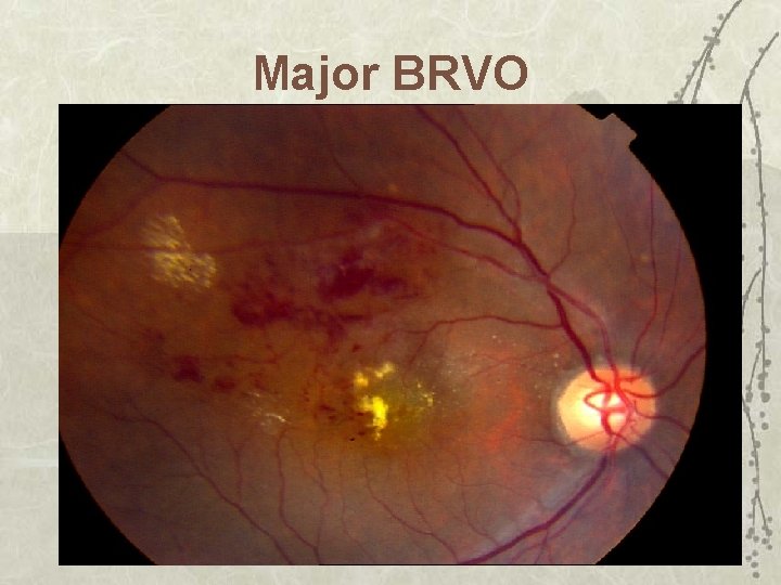 RETINAL VEIN OCCLUSION Dr KN POORNESH WGH 03