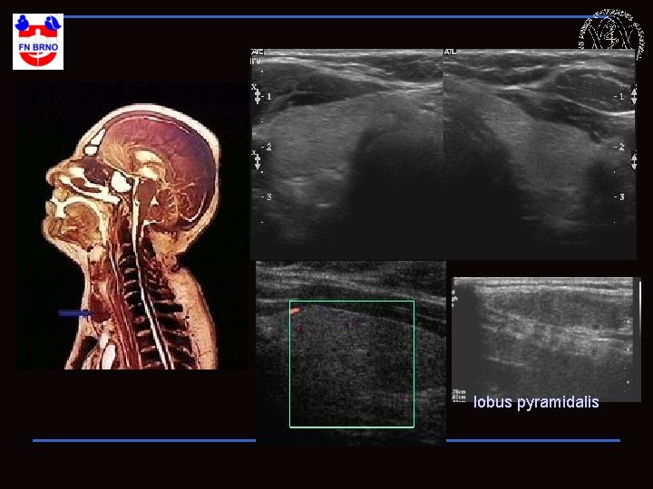Anatomie krku CT MR a UZ Bohat Neubauer