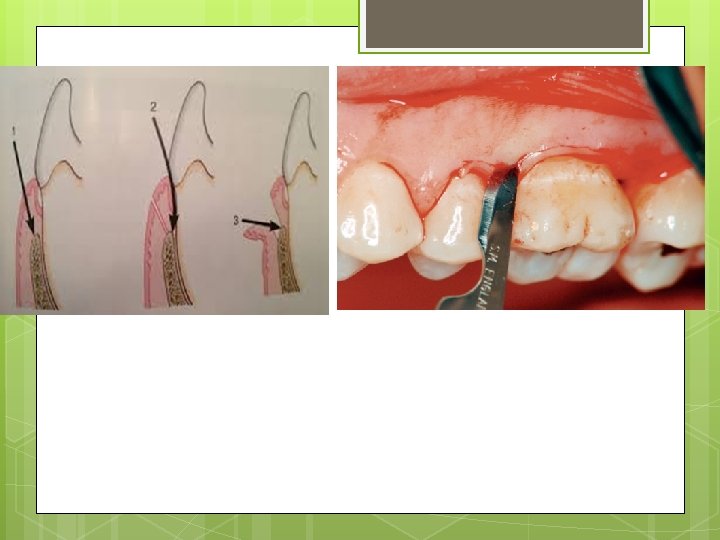 CORRECTIVE PHASE OF PD THERAPY Surgical phase CORRECTIVE