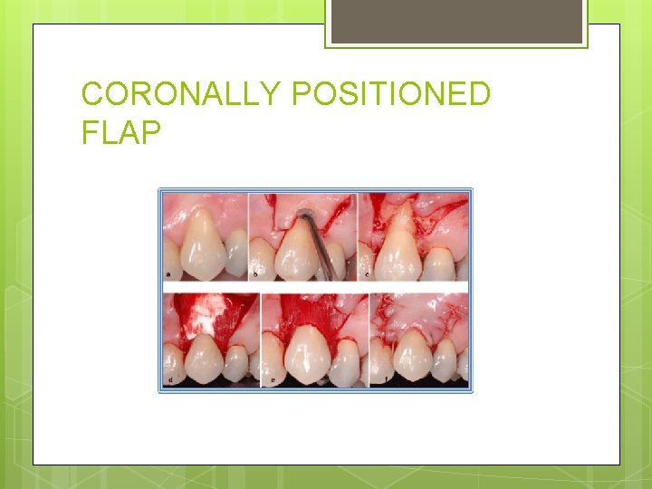 CORRECTIVE PHASE OF PD THERAPY Surgical phase CORRECTIVE