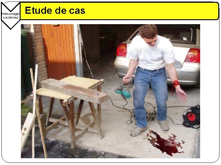 Hmorragie s externes Etude de cas LES HEMORAGIES