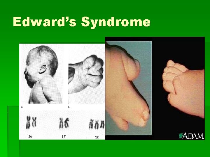Mutations and Chromosomal Disorders Mutation or birth defect