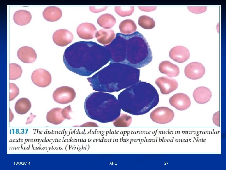 Acute Promyelocytic Leukemia APL By Maged Abd El