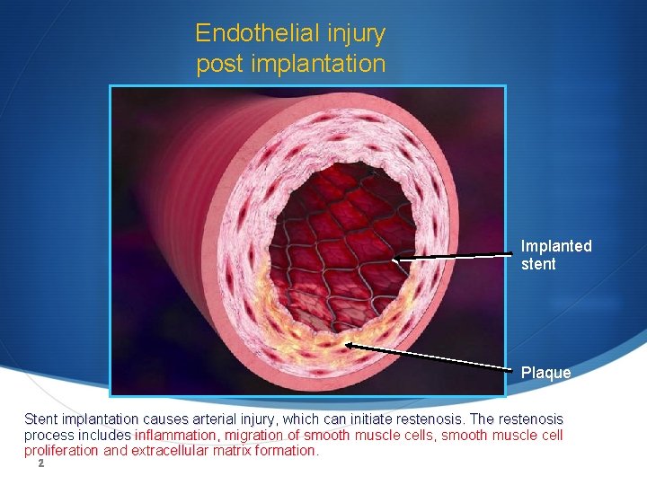 Endothelial injury post implantation Implanted stent Plaque Stent