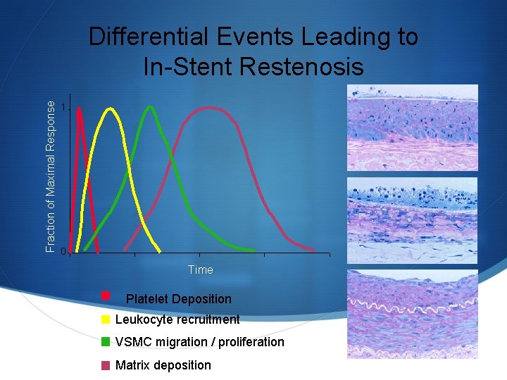 Endothelial injury post implantation Implanted stent Plaque Stent