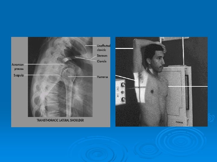 UNIT 3 RADIOGRAPHY OF THE SHOULDER GRIDE Radiography