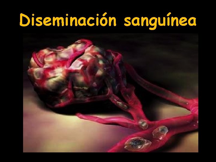 Diferentes Subtipos de Cncer de Mama Infiltrante y