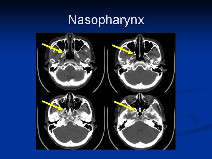 Contents Nasopharynx n Oral cavity n Ear external