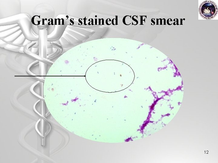 MALDI TOF analysis of Streptococcus pneumoniae from Cerebrospinal