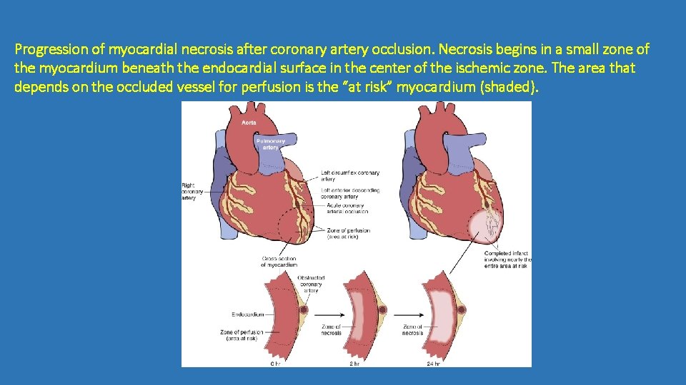Ischemic Heart Disease Acute Myocardial Infarction Cora UramTuculescu