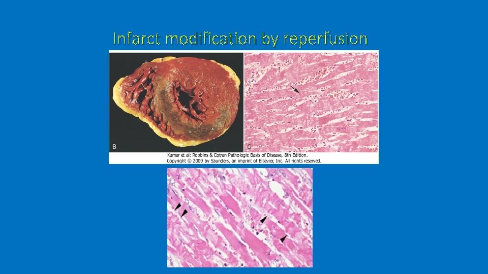 Ischemic Heart Disease Acute Myocardial Infarction Cora UramTuculescu
