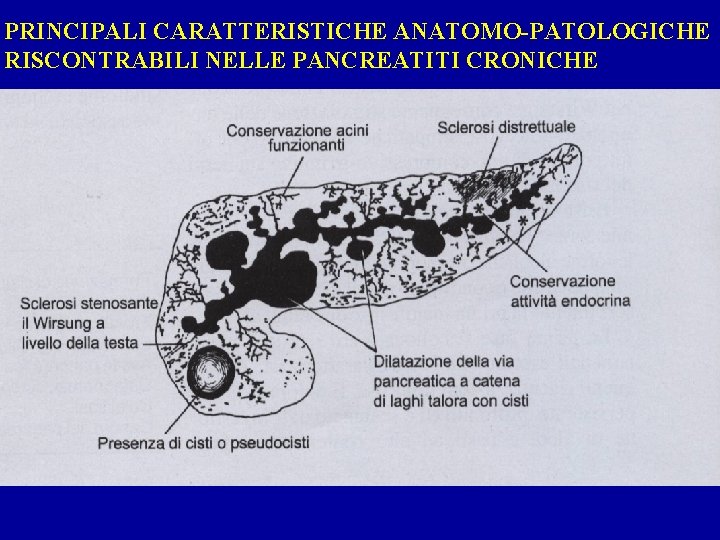 PANCREATITE ACUTA La pancreatite acuta un processo infiammatorio