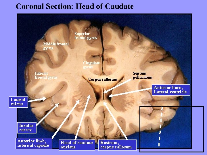 Sectional Anatomy of the Brain Dr G R