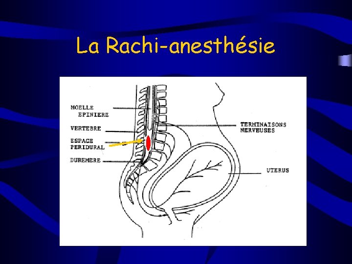 Anesthsie locorgionale Octobre 2005 Plan Gnralits Anesthsies primdullaires