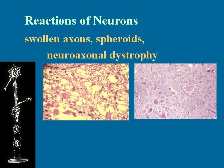 Pathologic Responses of the Nervous System GROSS CHANGES