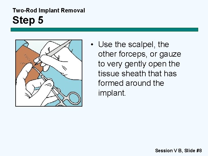 Contraceptive Implants Session V B TwoRod Implant Removal